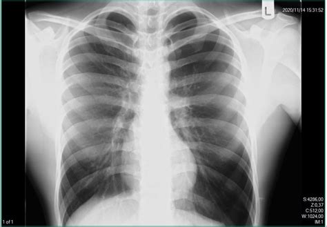 Is There A Pneumothorax On This X Ray R Pneumothorax