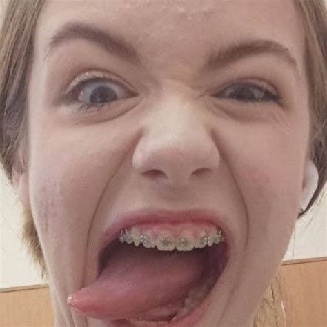 Create Meme Teeth After Removing Braces Braces On Teeth Damon Clear Braces Pictures Meme