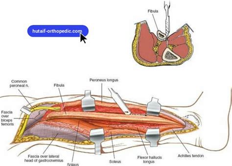 Fibula Diagram