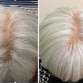 Temporal Scalp Pre And Post Treatment Download Scientific Diagram