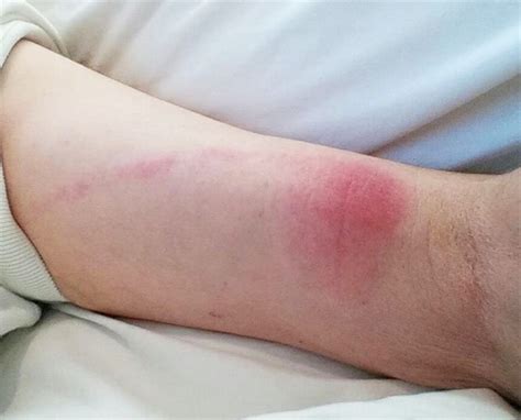 Treatment Of Insect Bite Cellulitis At Sienna Schaw Blog