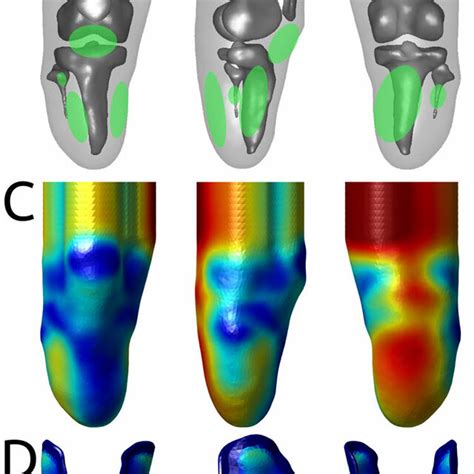 Controlling Design Features The Residual Limb With Vulnerable