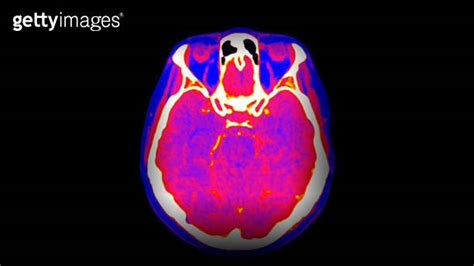 Ct Brain Perfusion Or Ct Scan Image Of The Brain Axial View 1931322105 게티이미지뱅크