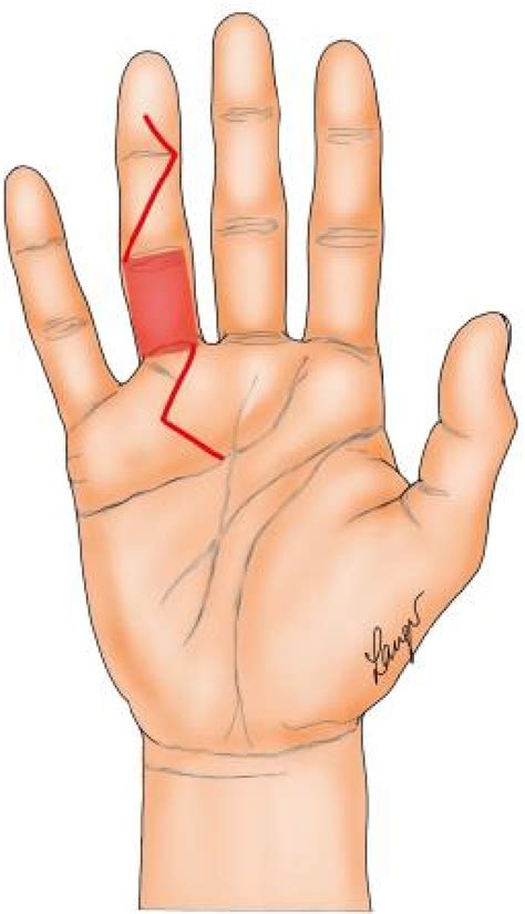 Figure 8 From Surgical Treatment For Dupuytren S Disease Open