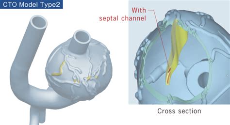 Cto Model Heartroid