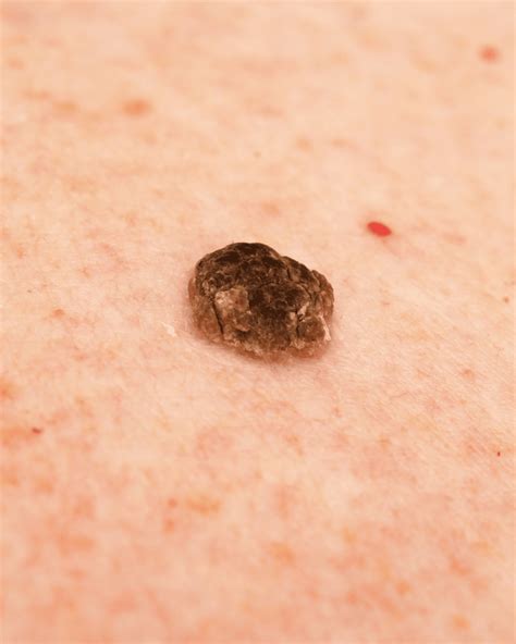 Seborrhoeic Keratosis Thomson Medical