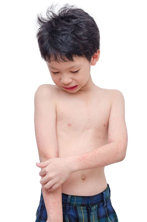 Severity Of Atopic Dermatitis Increases Disease Burden