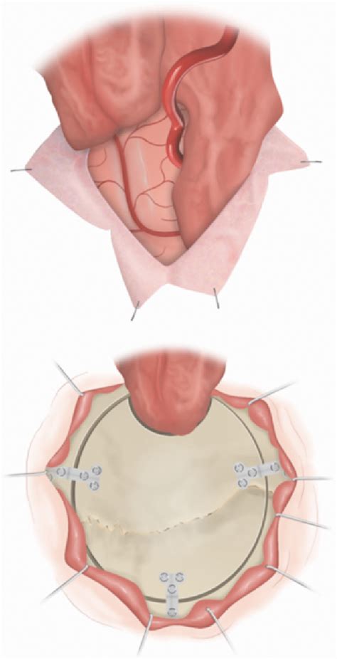 Figure 2 From Pedicled Temporoparietal Fascial Flap For Combined