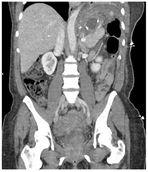Initial Ct Showing Luq Abscess Download Scientific Diagram