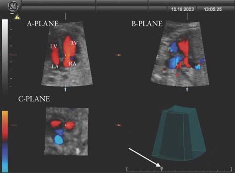 Color Doppler Spatio Temporal Image Correlation Volume Of A 26 Week Download Scientific Diagram