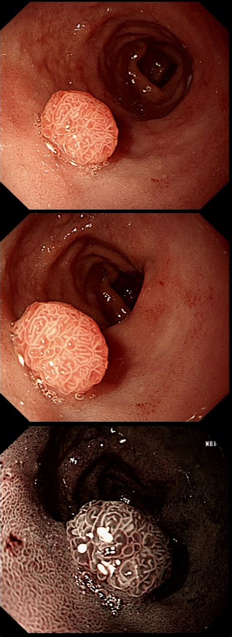 Latest Learning Case Friends Of Endoscopy