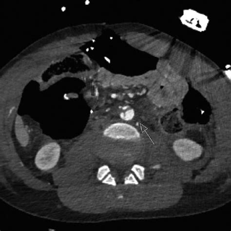 Abdominal Ct Scan After Laparotomy Showing A Short Intimal Laceration Download Scientific