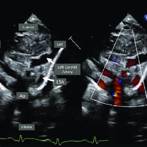 Echocardiography Suprasternal Long Axis Image And Video Video 4