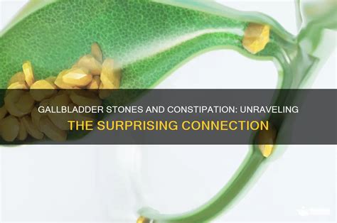 Gallbladder Stones And Constipation Unraveling The Surprising