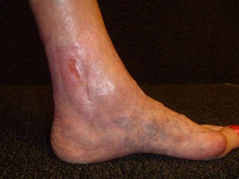 Swollen Feet 10 Causes Of Swollen Feet