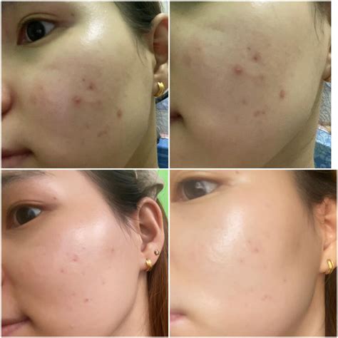 ဝက်ခြံကြောင့် အမာရွတ်တွေအများကြီးကျန်မှာ စိတ်ပူနေတဲ့သူတွေအတွက် Cosrx Advanced Snail 96 Mucin