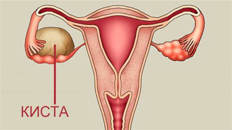Киста яичника симптомы лечение причины признаки кисты яичника у женщин
