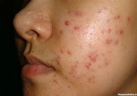 31 عکس از زیبایی در چهره جوش دار