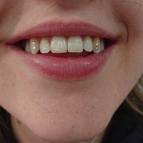 Swarovski Tooth Crystals