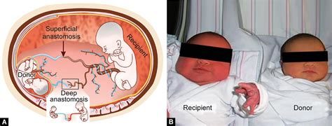 Twin To Twin Transfusion Syndrome