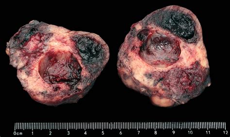 Pathology Outlines Gastrointestinal Stromal Tumor