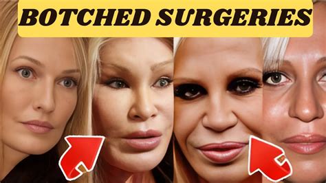 Botched Plastic Surgeries Ever Celebrities Plastic Surgeries Gone
