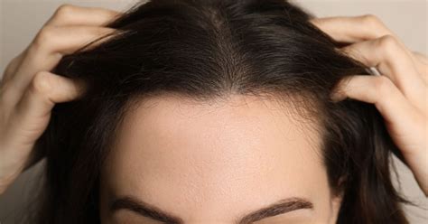 Exclamation Point Hairs A Sign Of Alopecia Areata Canadian Alopecia