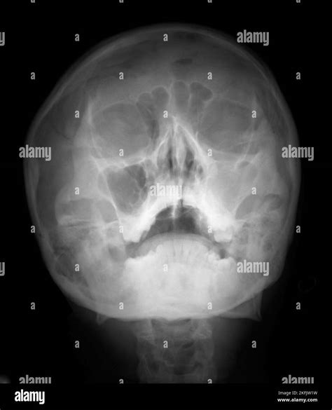 Sinus Blockiert Fotos Und Bildmaterial In Hoher Auflösung Alamy