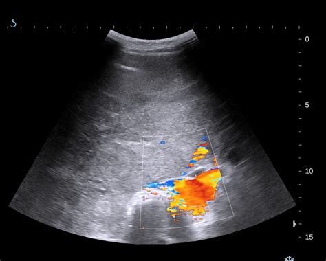 Vietnamese Medic Ultrasound Case 390 Pedunculated Hcc Dr Phan Thanh