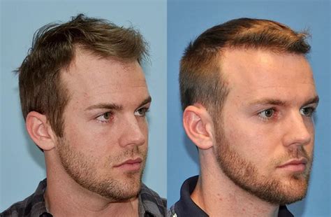 Hair Transplant Before And After Photos Celebrity Men And Women