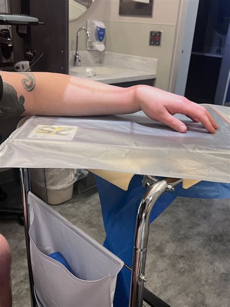 Broke Both Of My Arm Bones And Had To Get The Top Bone Reset R
