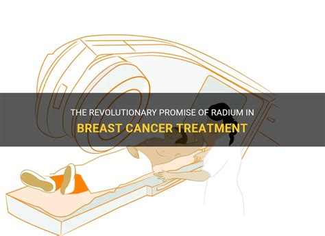 The Revolutionary Promise Of Radium In Breast Cancer Treatment Medshun