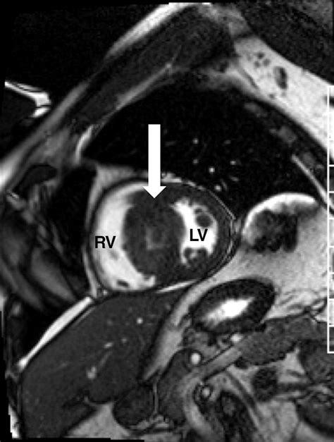 Case 274 Cardiac Echinococcus Radiology