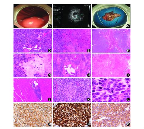 Clinical Features He And Ihc Results Of The 15 Ggt Cases A Case
