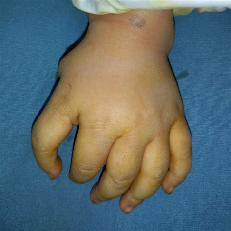 Thumb Triphalangeal Deformity Surgery China Thumb Triphalangeal Deformity Surgery