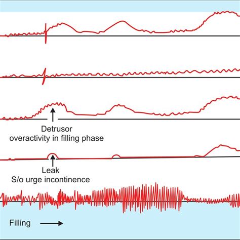 2a To E Common Uroflowmetry Curves A Normal Bell Shaped Curve B Download Scientific