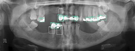 Deep Learning Object Detection On Dental X Rays Clement Joudet Medium