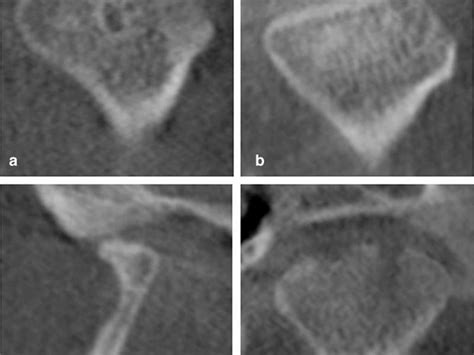 An Artificial Intelligence Model For The Radiographic Diagnosis Of