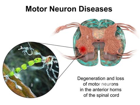 Motor Neuron Disease And Speech Pathology Neurological Speech