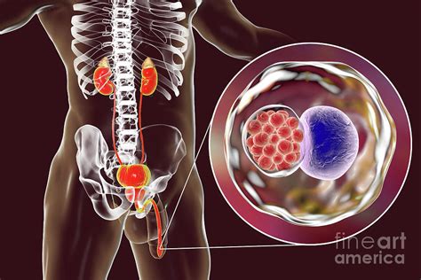 Chlamydia Infection Photograph By Kateryna Konscience Photo Library Pixels