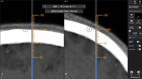 Cirq® For Functional Neurosurgery Robotic Surgery Brainlab
