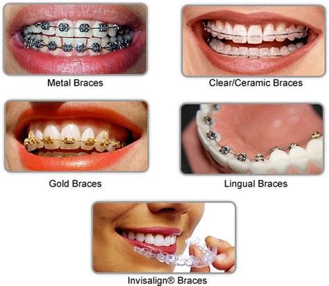 To Live A Life Worth Living Braces Pendakap Gigi