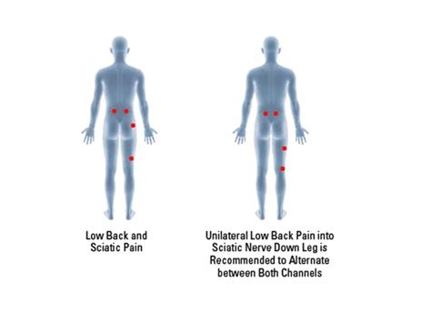 Tens Unit Placement Chart