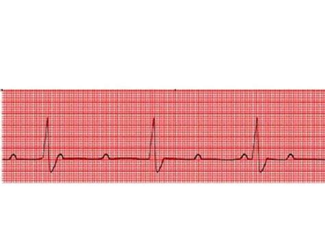 EKG Interpretation Flashcards Quizlet