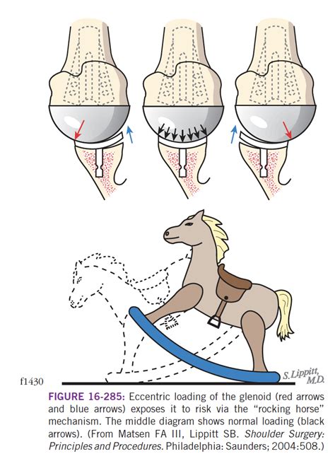 Shoulder Arthritis Joint Replacement Glenoid Component Loosening