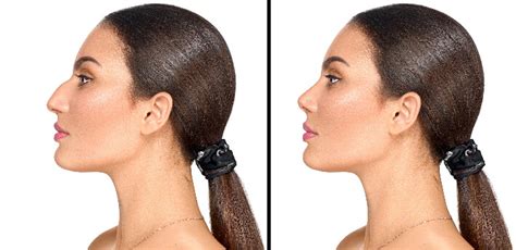 Nasal Aesthetics Nose Conditions And Procedures Worcestershire Ear