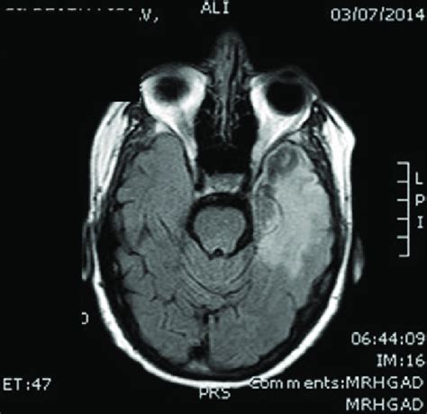 1 Mri Of Patient With Hse Showing Temporal Lobe Enhancement On T2 Flair Download Scientific
