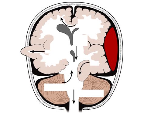 Brain Herniations Quiz