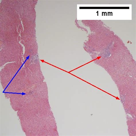 Hepatitis C Libre Pathology
