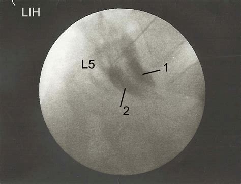 Blockade Of The Superior Hypogastric Plexus Lateral View Notes 1